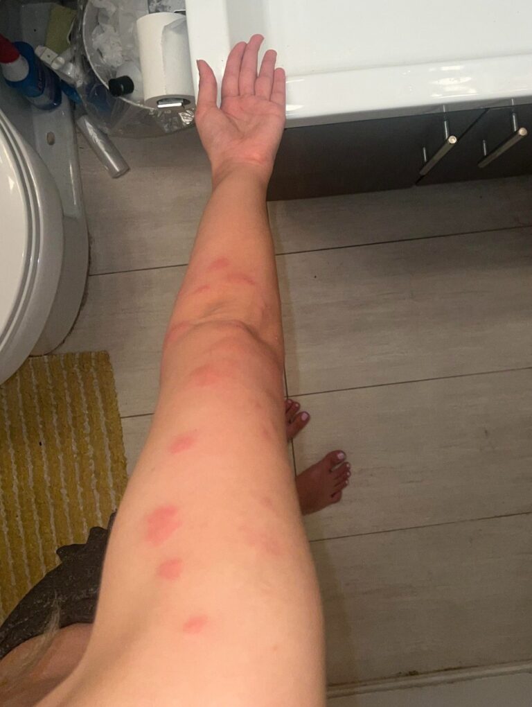 How To Identify 10 Of The Most Common Bug Bites - Best Recipes